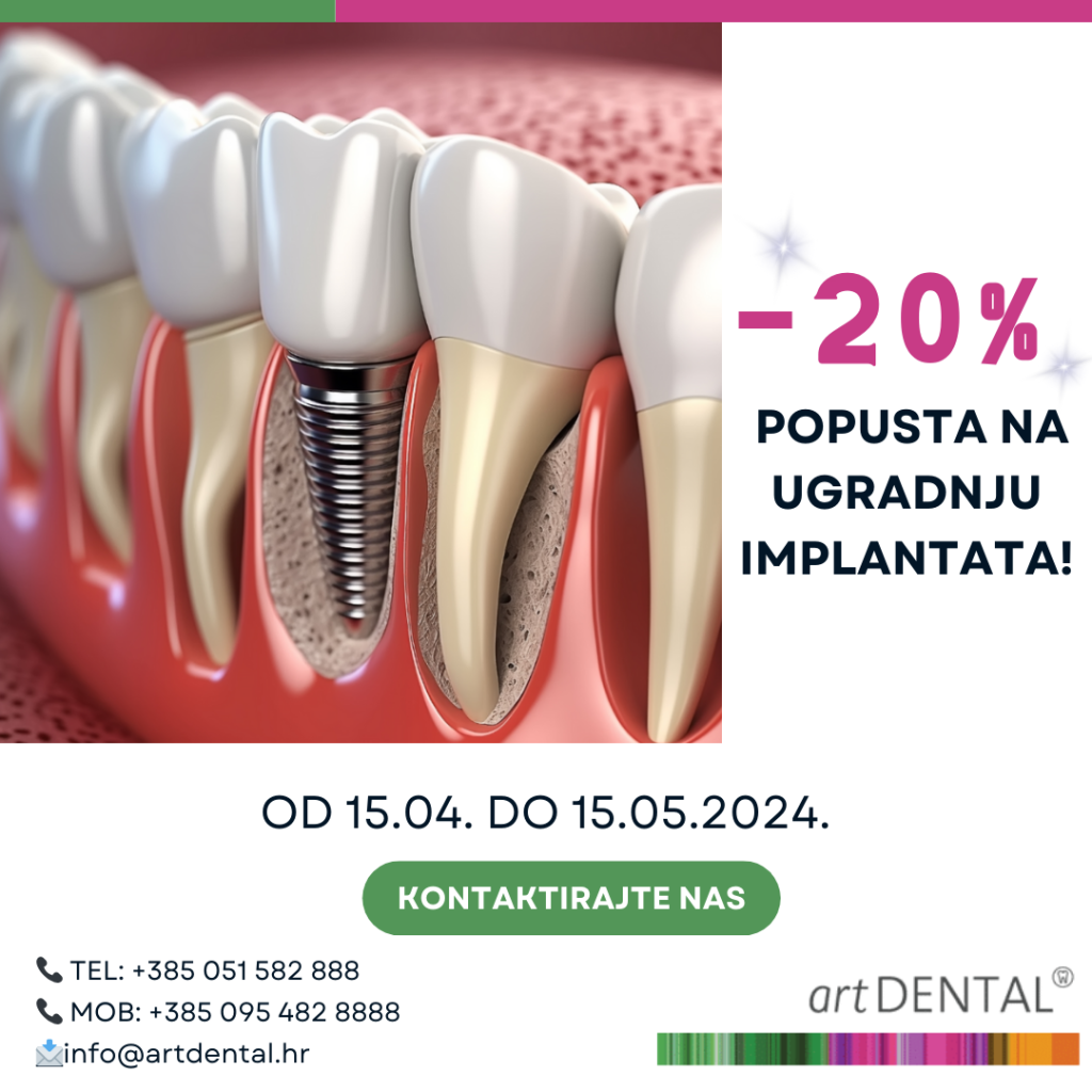 20% popusta na ugradnju Implantata u artDENTALU